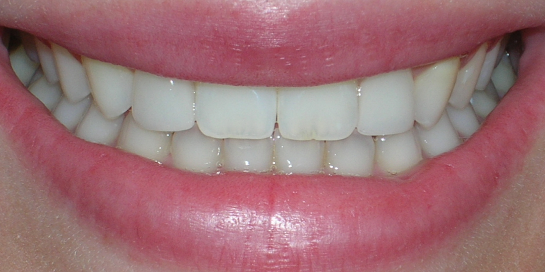 Smile Gallery - Photos of Our Amazing Smile Transformations
